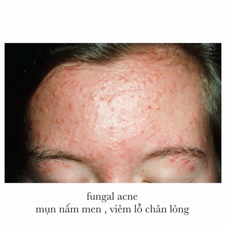 Phân biệt giữa mụn ẩn và mụn nấm men. Cách điều trị hiệu quả. – Tinh tế ...